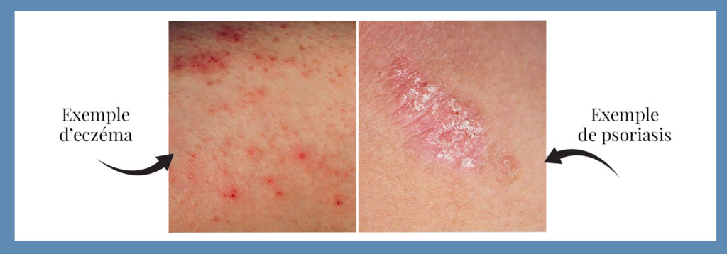 Comment traiter naturellement l’eczéma et le psoriasis