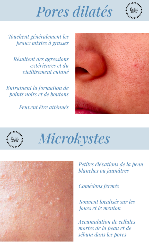 Comment éliminer les points noirs sur le nez et le visage